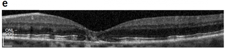 Micron IV Fundus Images Reveal Recapitulation of Phenotype in Retinal ...