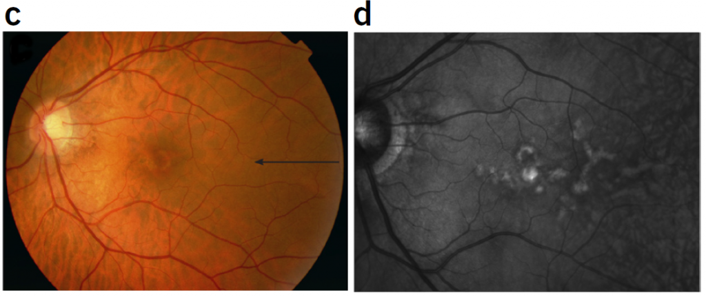Micron IV Fundus Images Reveal Recapitulation of Phenotype in Retinal ...