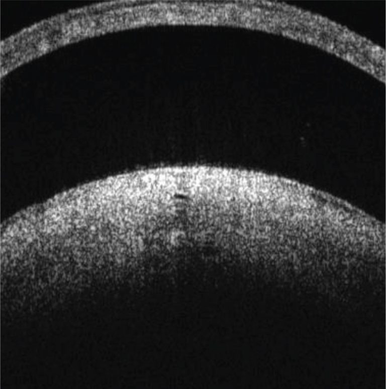 Anterior Segment Imaging - Phoenix-Micron