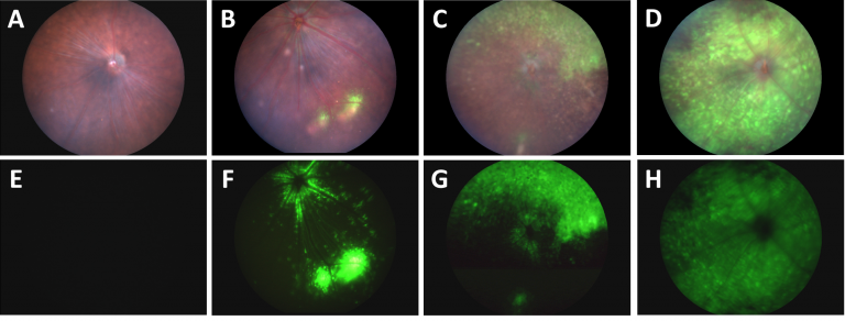 Stunning fundus images of GFP-positive cells demonstrate new ...