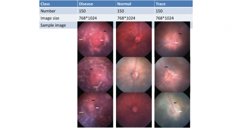 Deep learning provides unbiased evaluation of uveitis severity levels ...